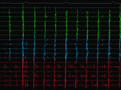 EP Essentials - Electrophysiology Education