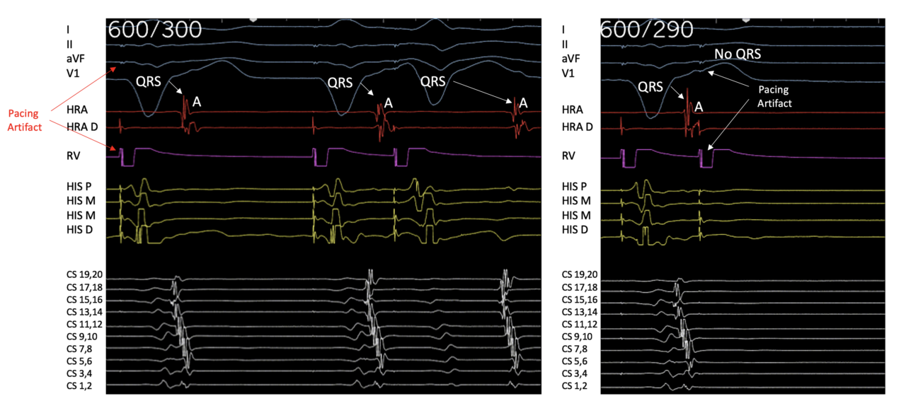 Electrogram Interpretation - 1 - EP Essentials