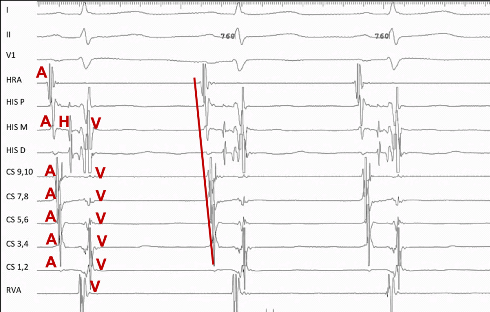 SVT Case Study - EP Essentials