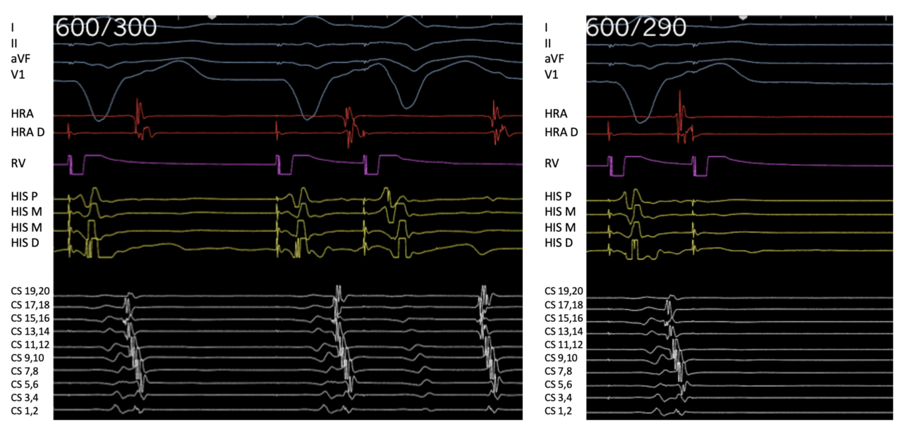 Electrogram Interpretation - 1 - EP Essentials