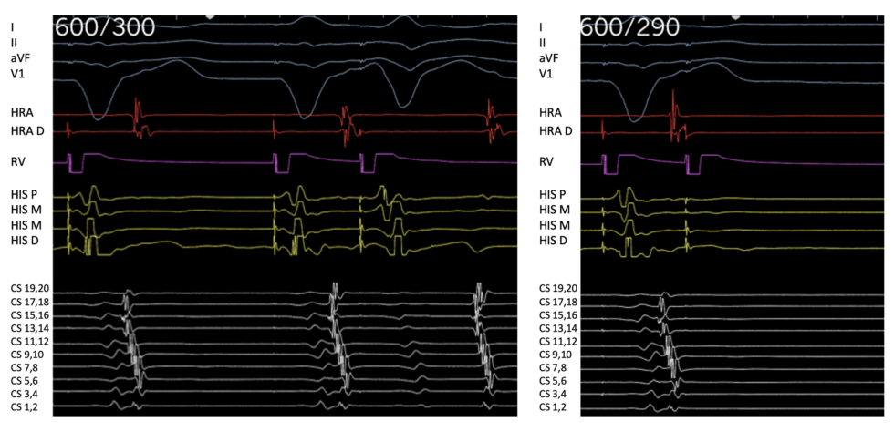 Electrogram Interpretation - 1 - EP Essentials