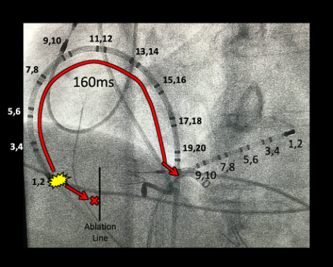Electrogram Interpretation - 3 - EP Essentials