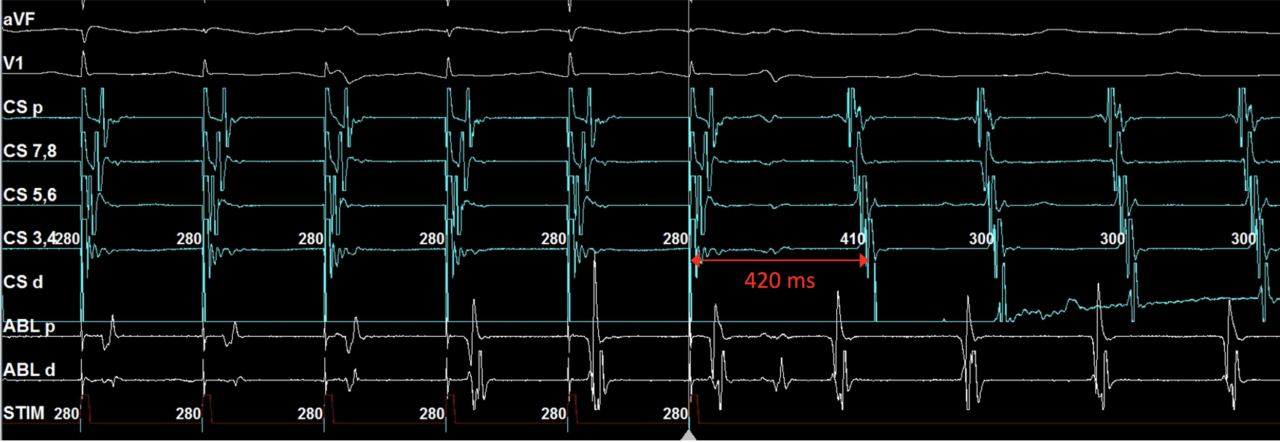 Electrogram Interpretation - 2 - EP Essentials