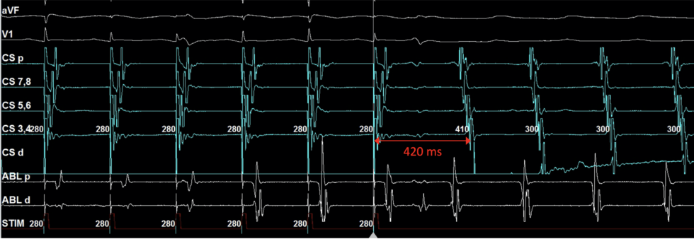 Electrogram Interpretation - 2 - EP Essentials
