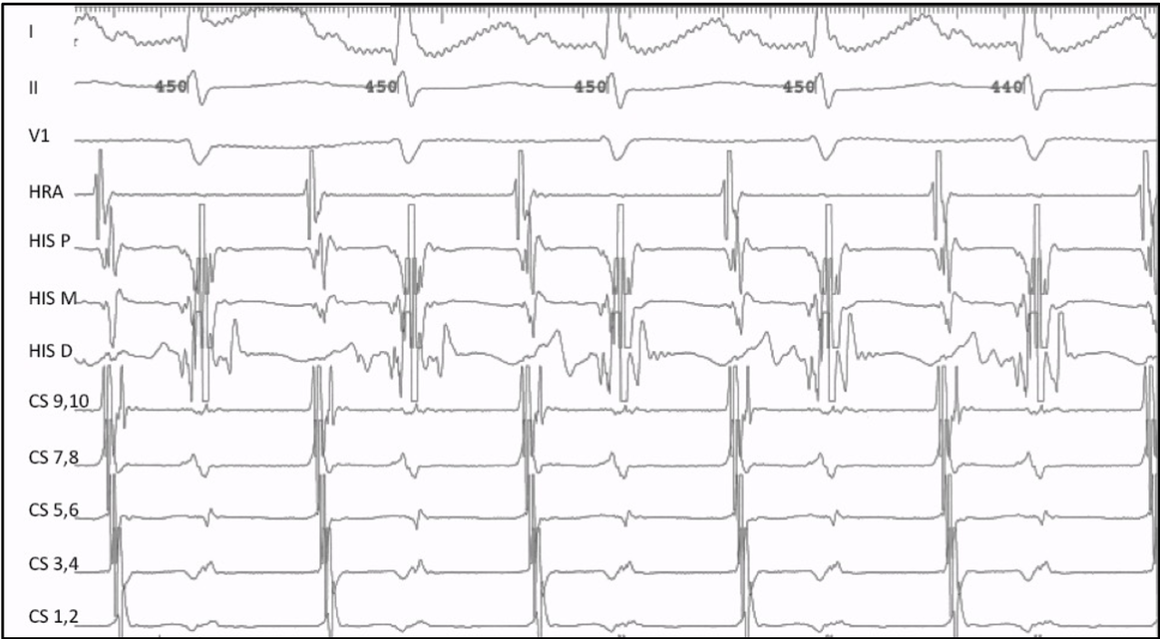 SVT Case Study - EP Essentials