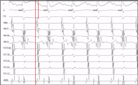 SVT Case Study - EP Essentials