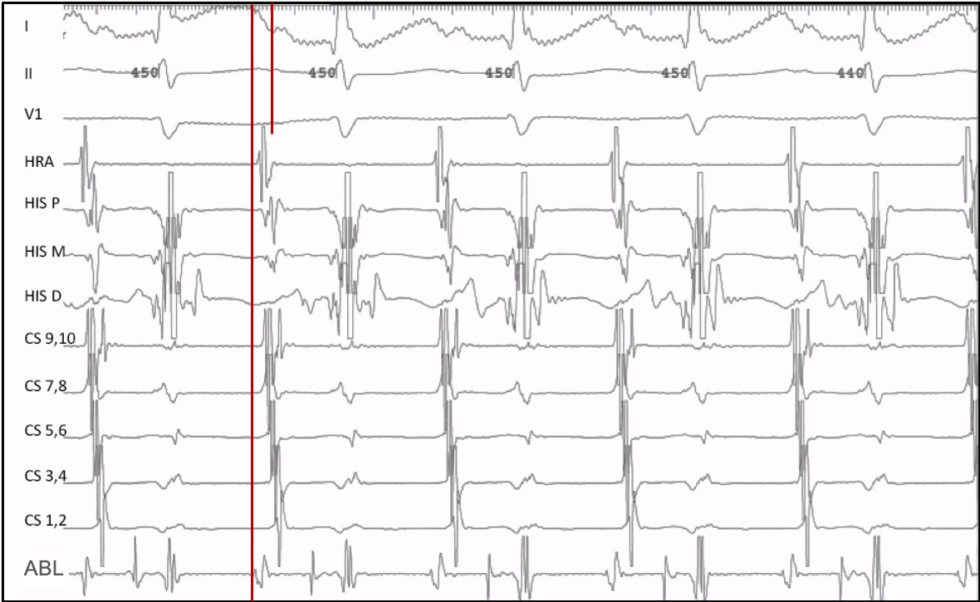 SVT Case Study - EP Essentials