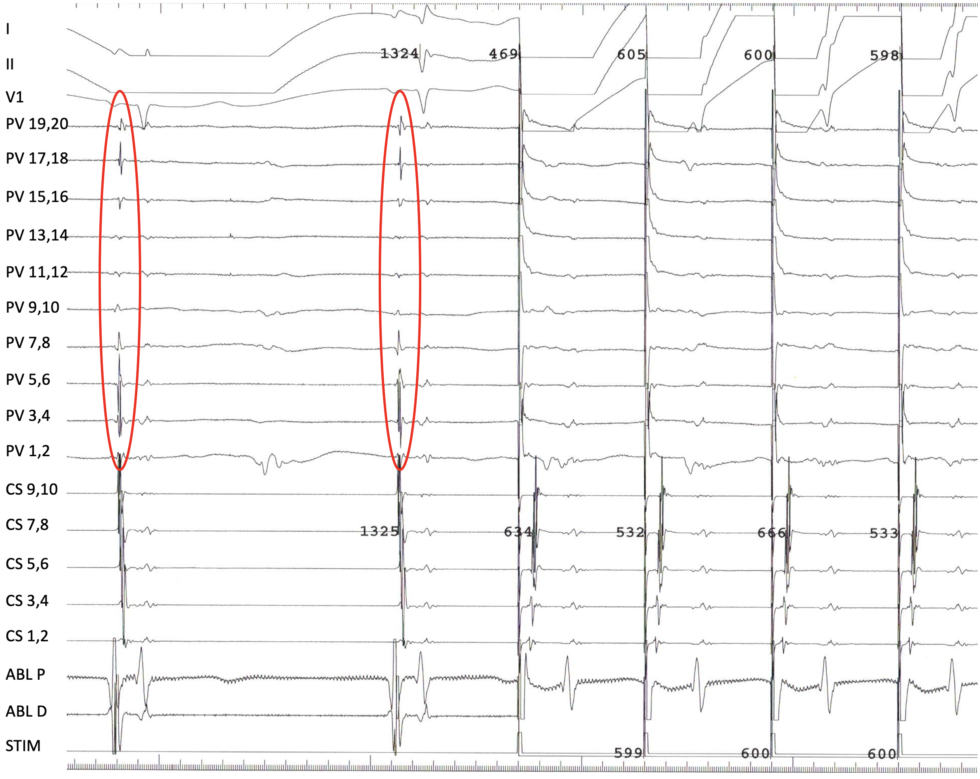 Electrogram Interpretation - 4 - EP Essentials