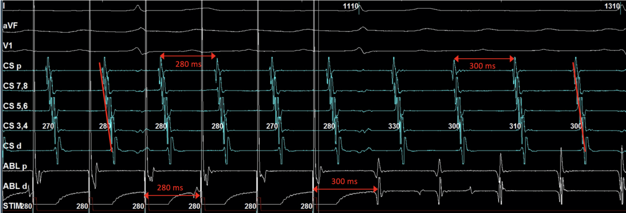 Electrogram Interpretation - 5 - EP Essentials