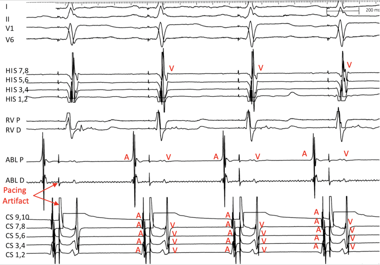 Electrogram Interpretation - 8 - EP Essentials