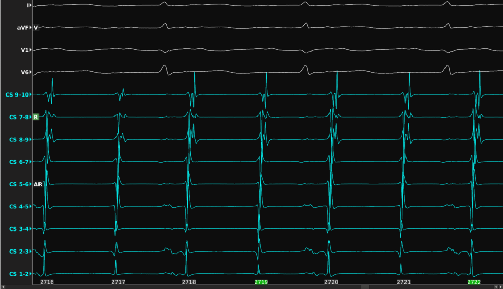 Electrogram Interpretation - 10 - EP Essentials