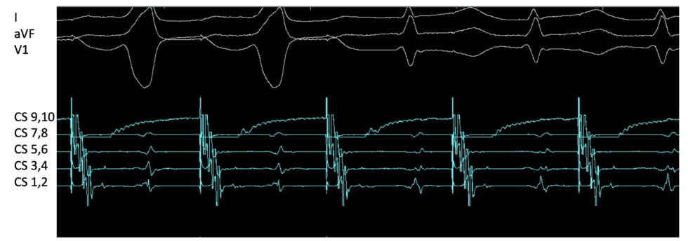 Electrogram Interpretation - 9 - EP Essentials