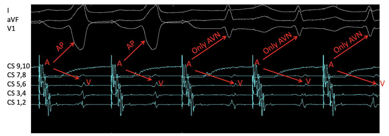 Electrogram Interpretation - 9 - EP Essentials