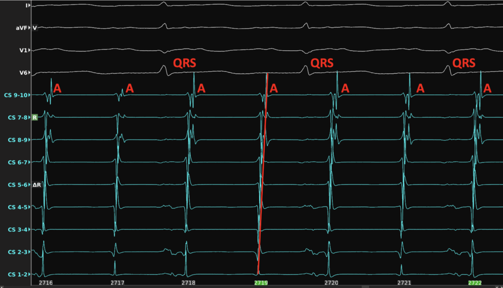 Electrogram Interpretation - 10 - EP Essentials