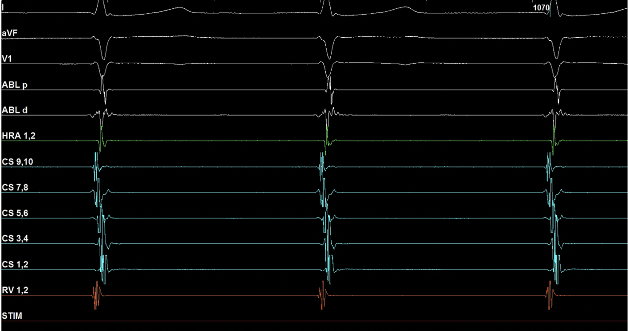 Electrogram Interpretation - 11 - EP Essentials