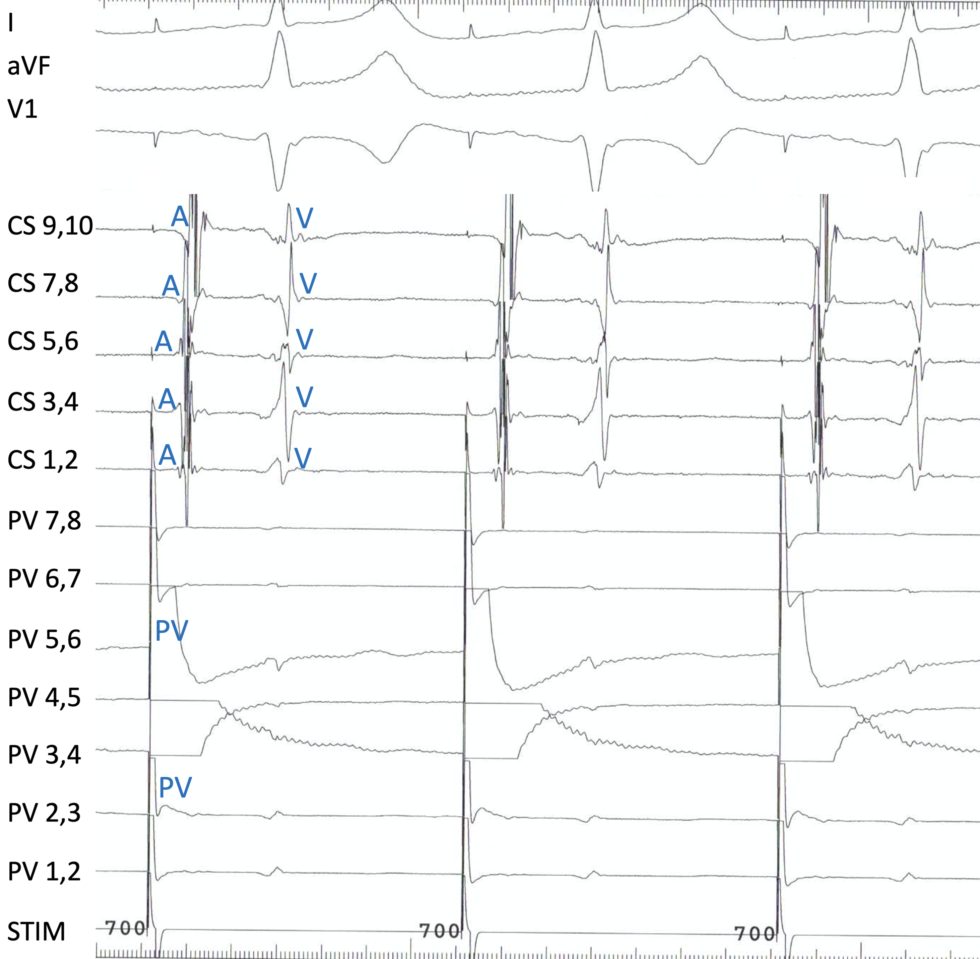 Electrogram Interpretation - 12 - EP Essentials