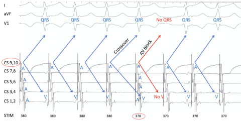 Electrogram Interpretation - 12 - EP Essentials