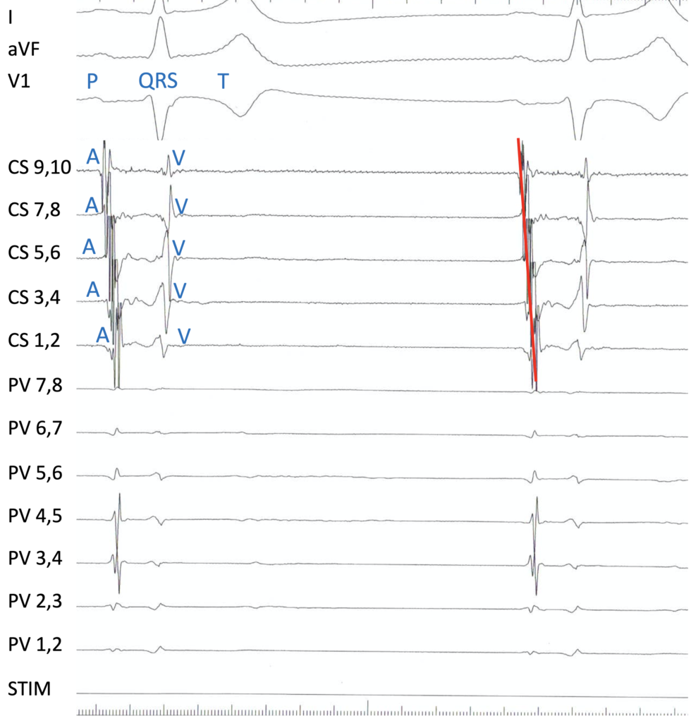 Electrogram Interpretation - 12 - EP Essentials