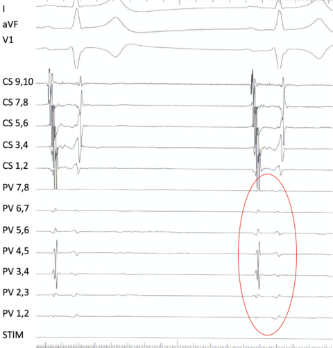 Electrogram Interpretation - 12 - EP Essentials