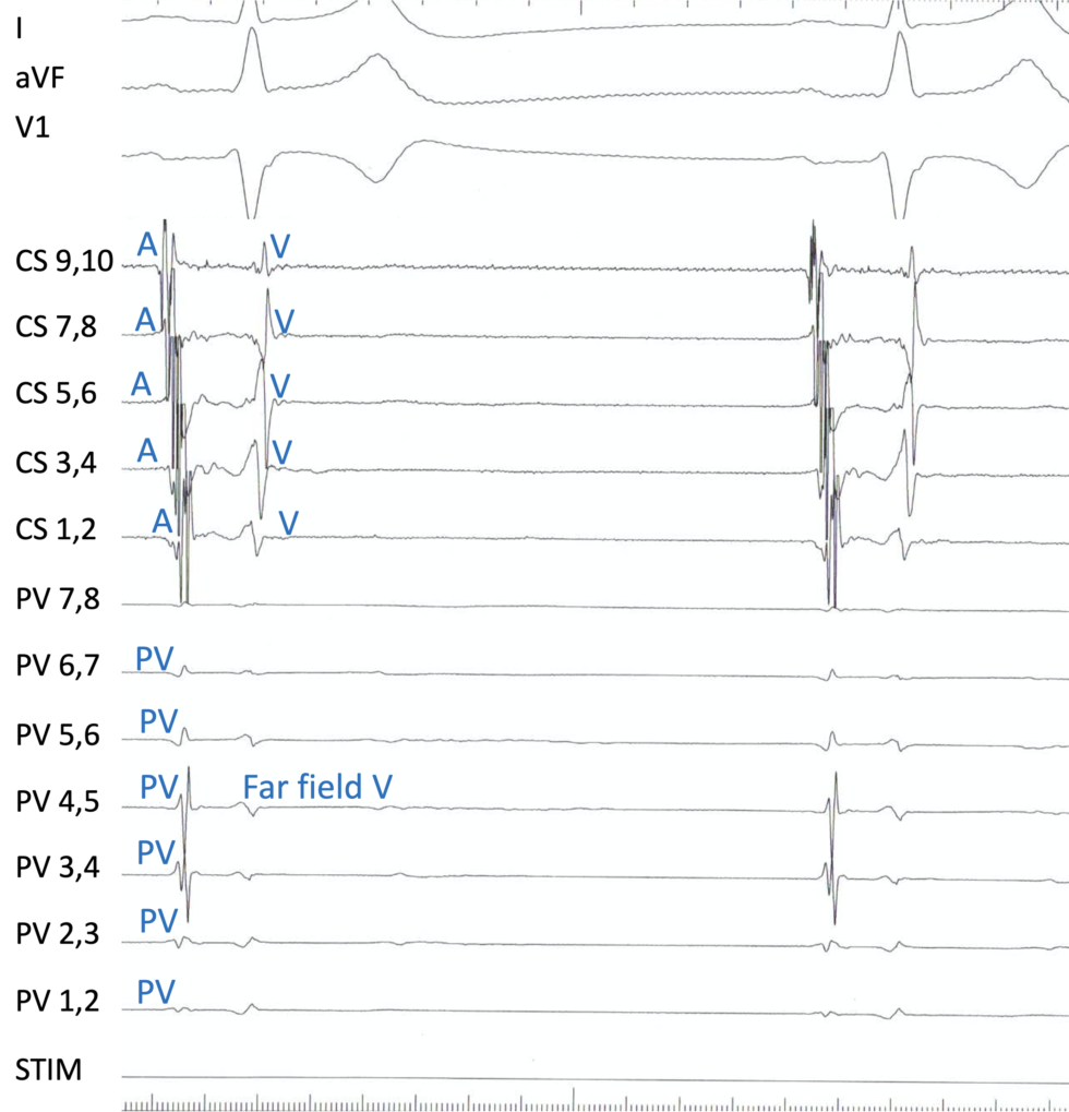 Electrogram Interpretation - 12 - EP Essentials