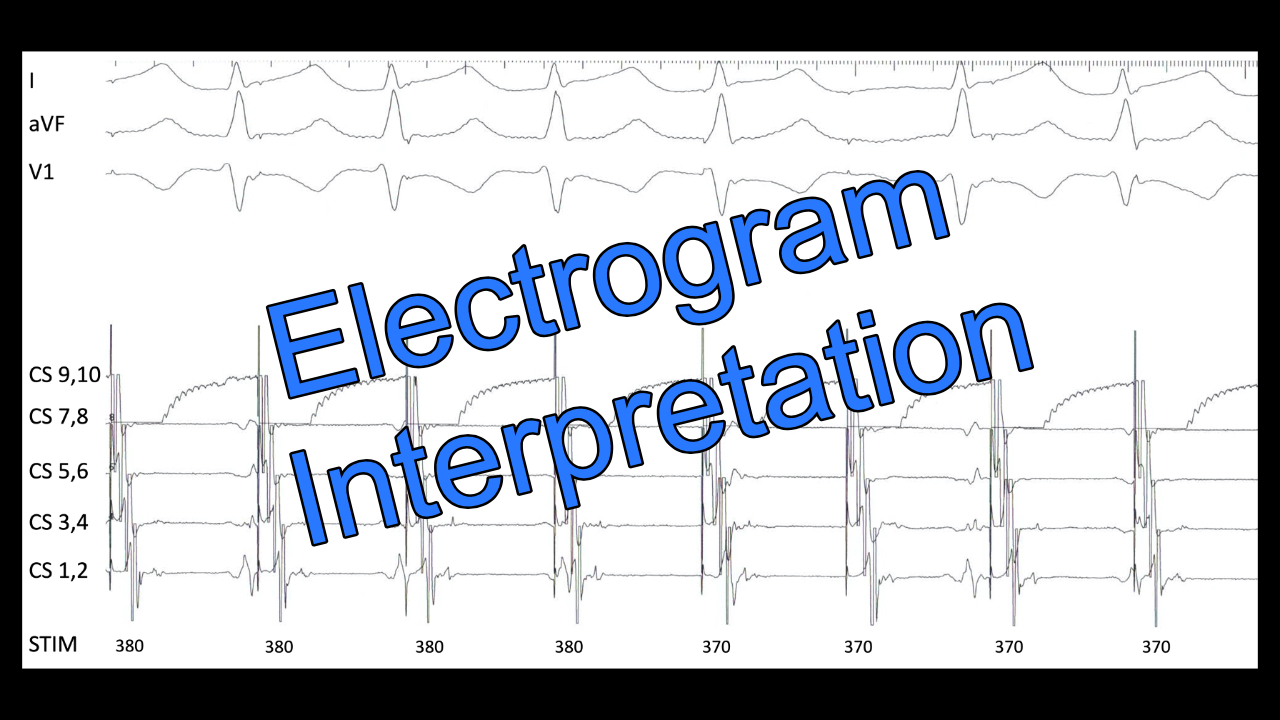Electrogram Interpretation - 12 - EP Essentials