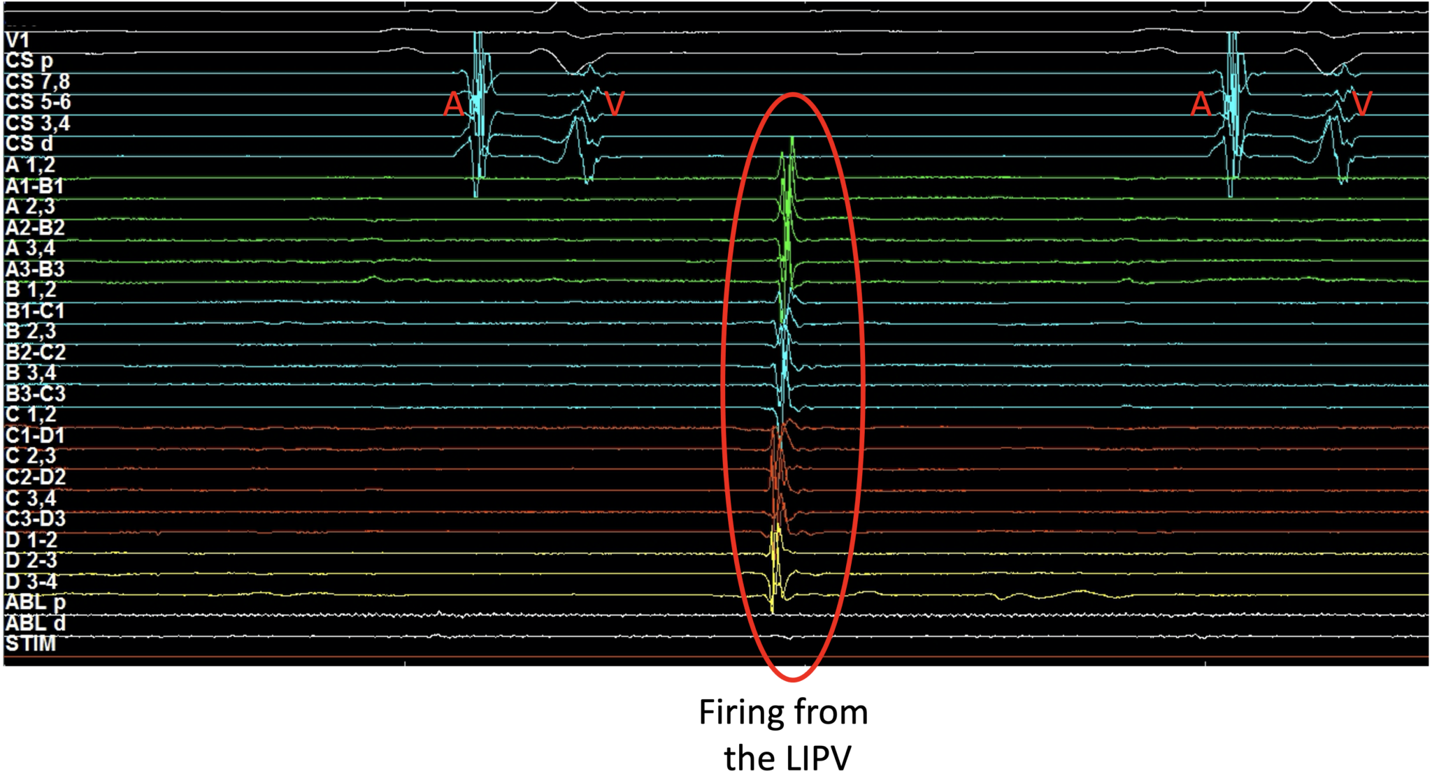 Electrogram Interpretation - 15 - EP Essentials