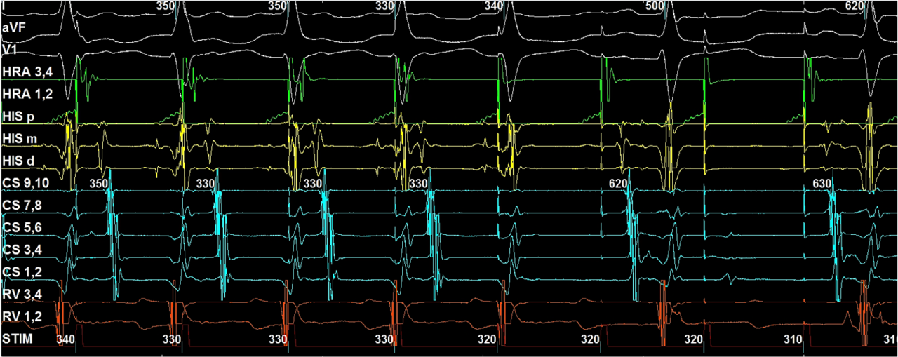 Electrogram Interpretation - 14 - EP Essentials