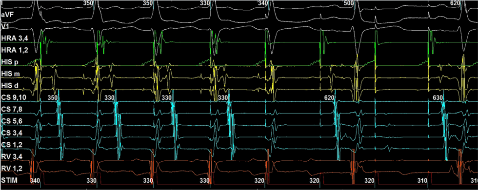 Electrogram Interpretation - 14 - EP Essentials
