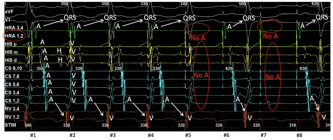 Electrogram Interpretation - 14 - EP Essentials