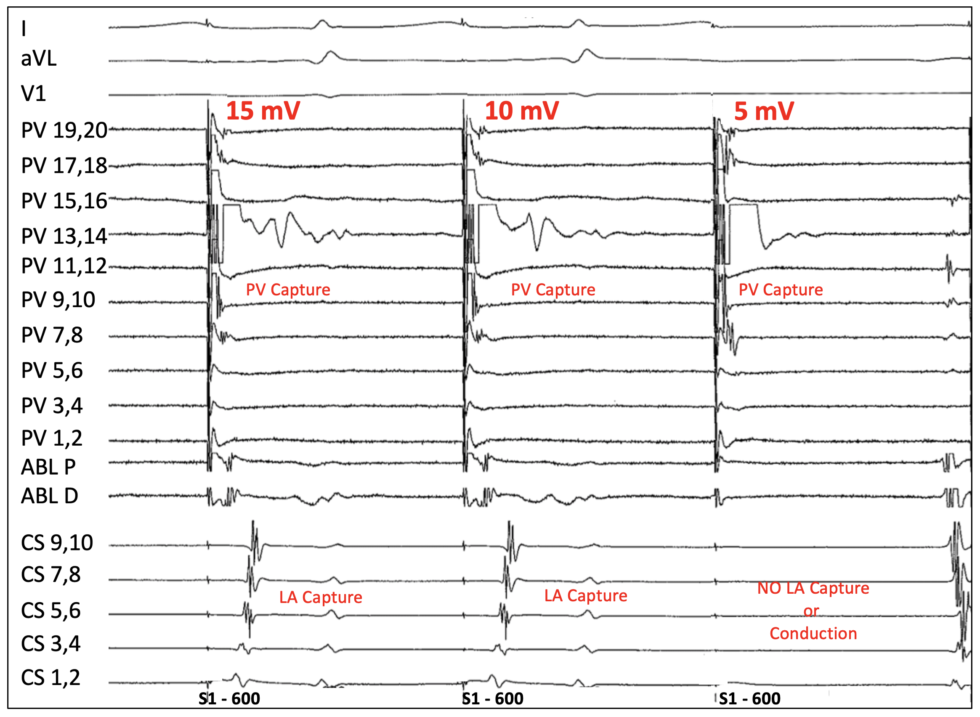 Electrogram Interpretation - 16 - EP Essentials