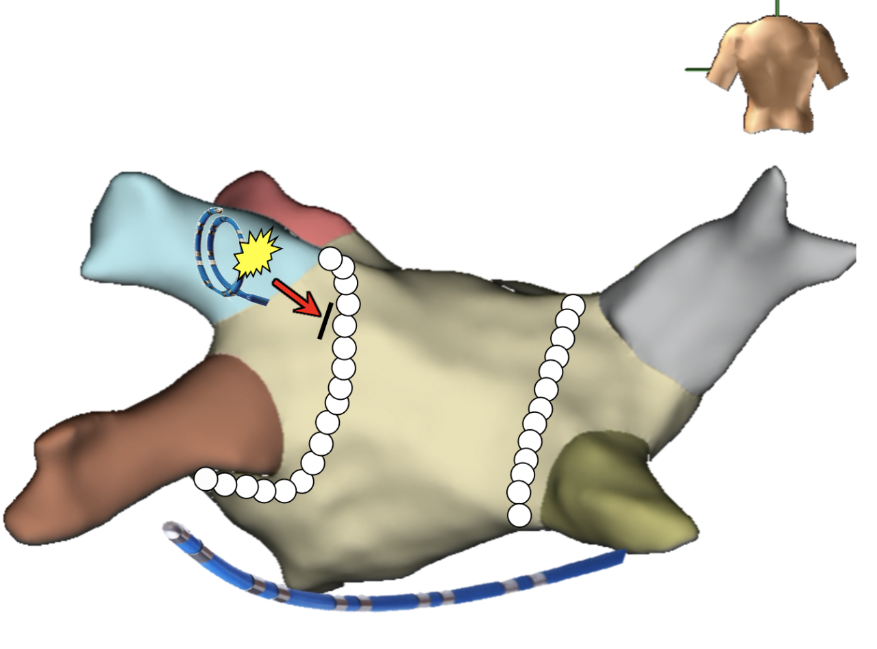 Electrogram Interpretation - 16 - EP Essentials