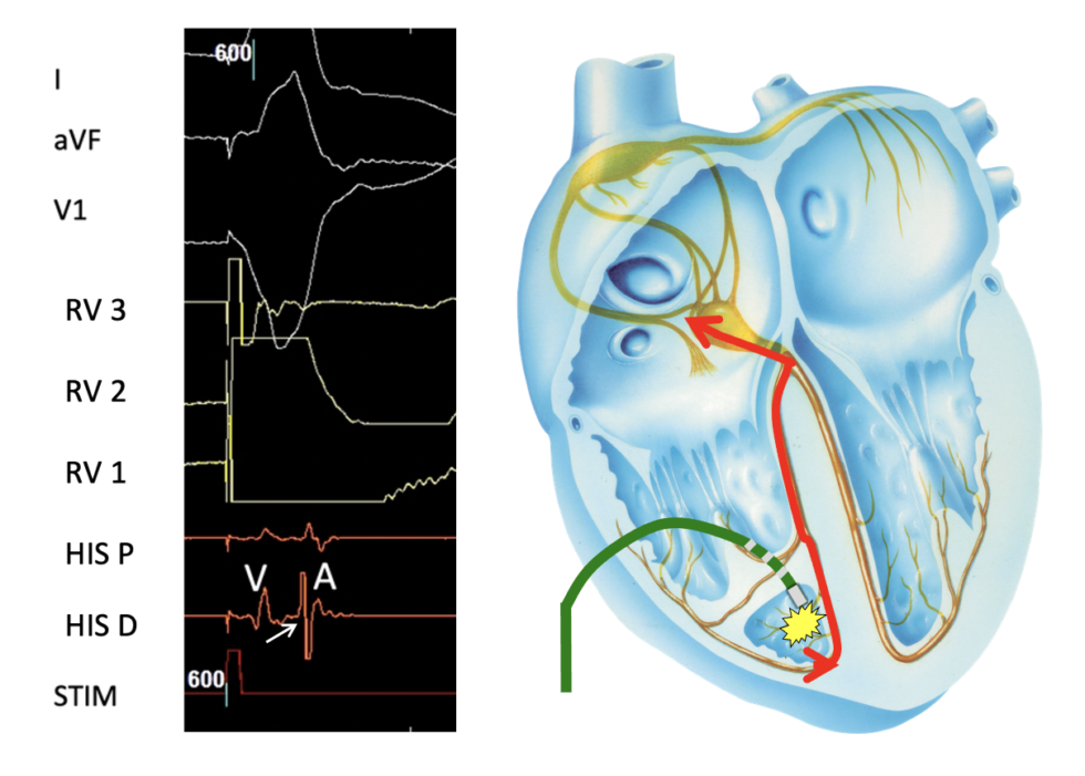 Electrogram Interpretation - 17 - EP Essentials