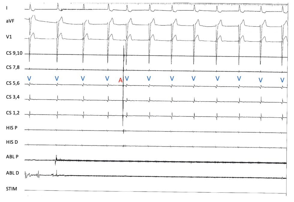 Electrogram Interpretation - 18 - EP Essentials