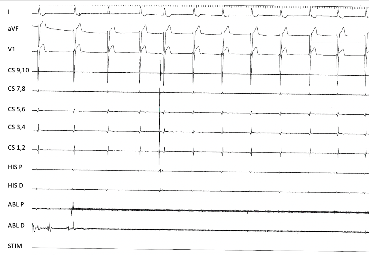 Electrogram Interpretation - 18 - EP Essentials