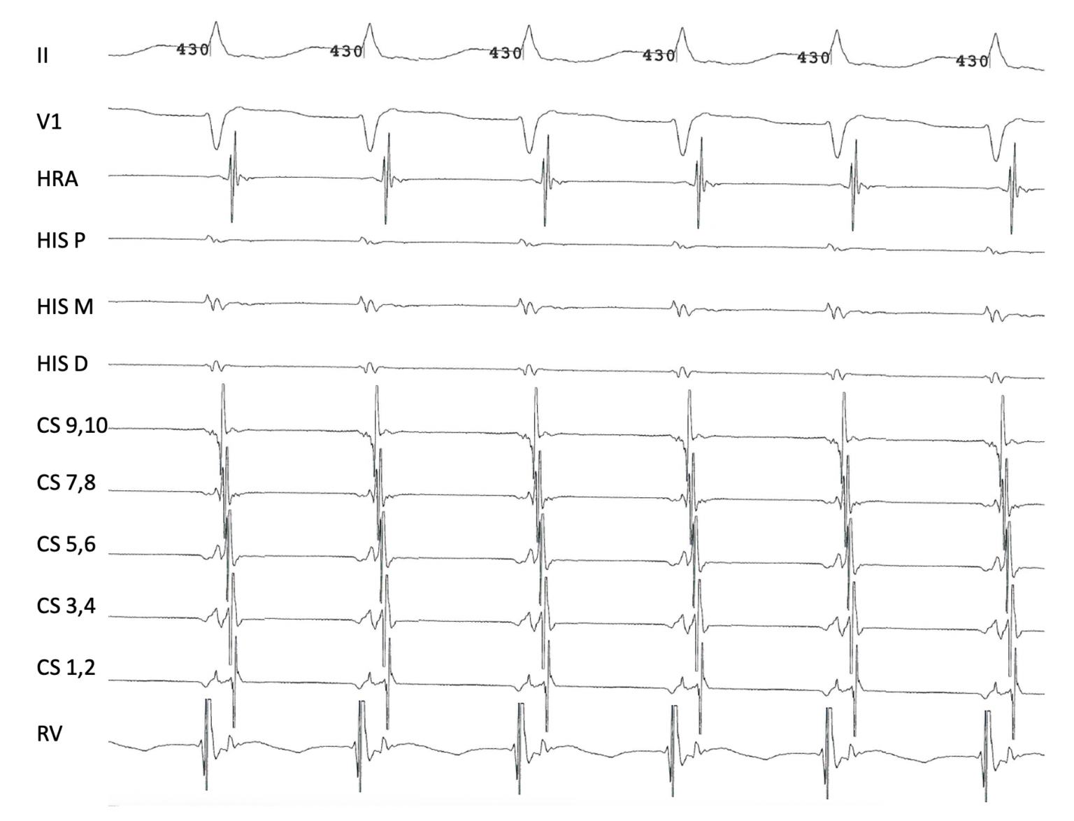SVT Case Study - #2 - EP Essentials