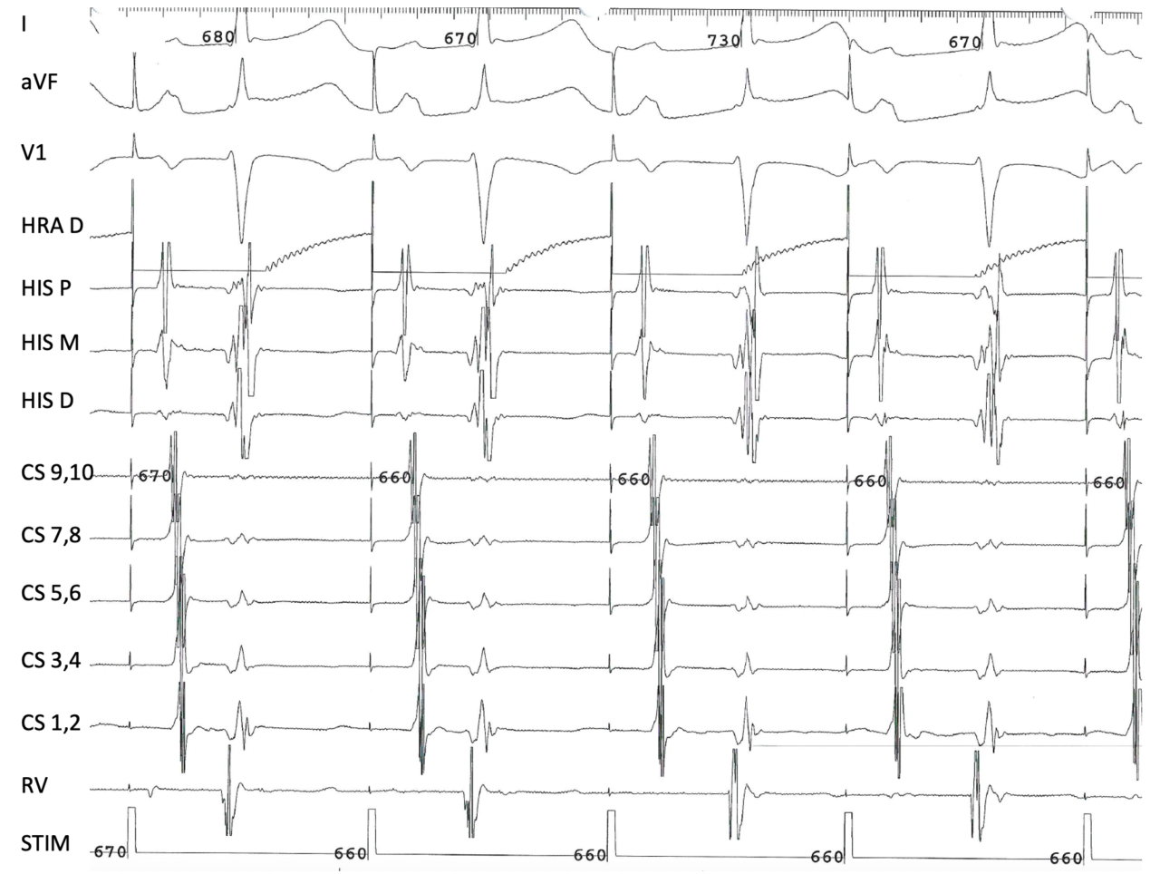 SVT Case Study - #2 - EP Essentials