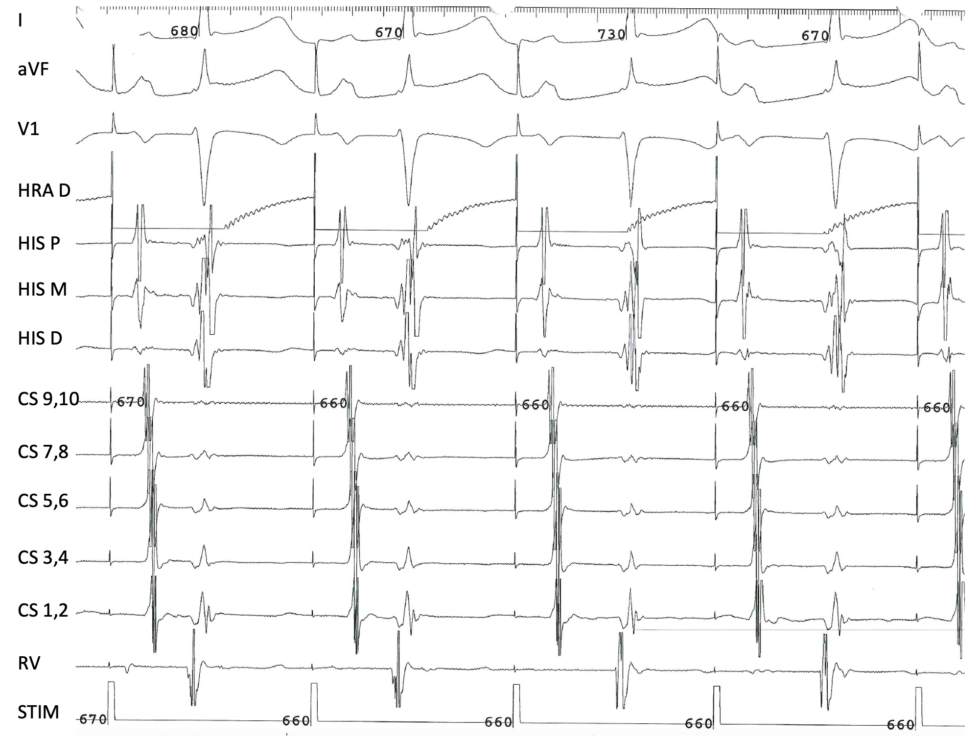 SVT Case Study - #2 - EP Essentials