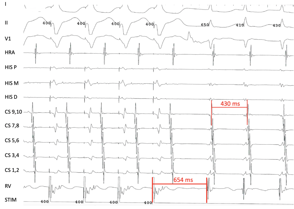 SVT Case Study - #2 - EP Essentials