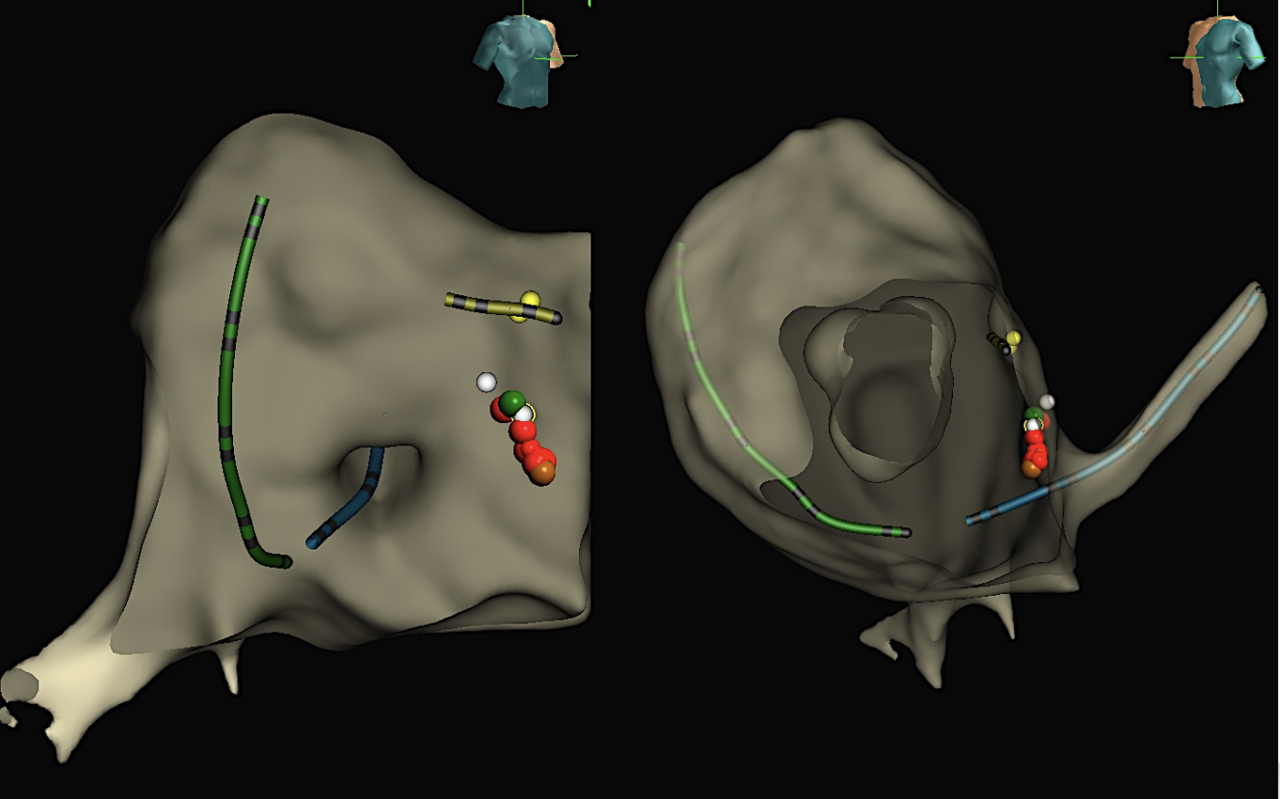 SVT Case Study - #2 - EP Essentials
