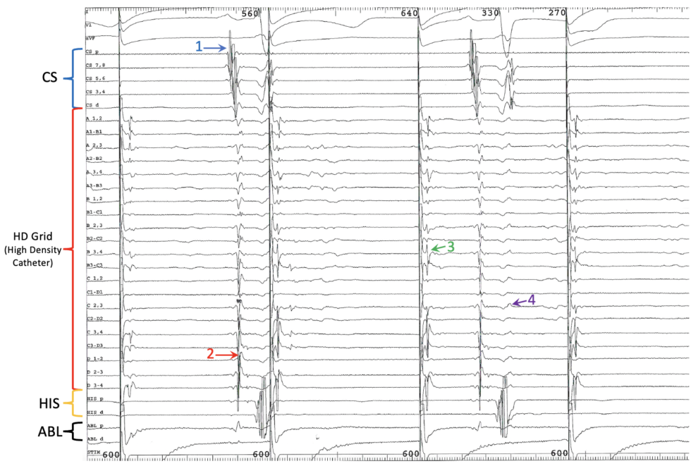 Electrogram Interpretation - 19 - EP Essentials