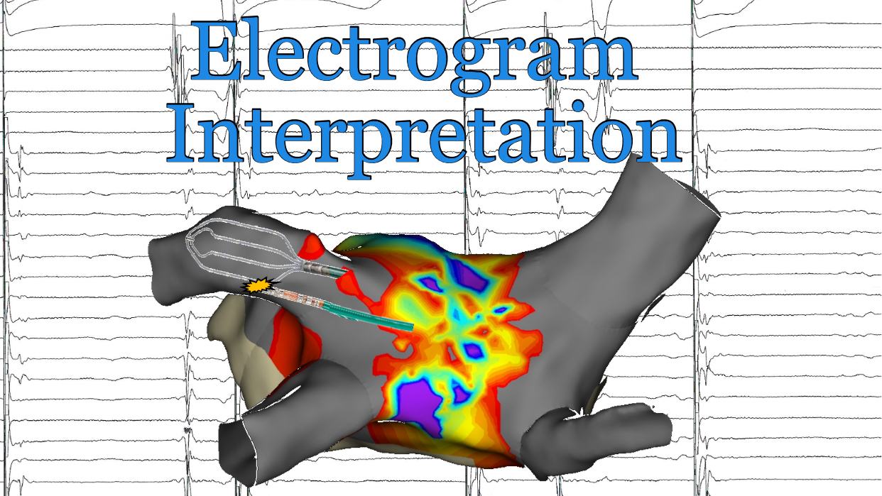 Electrogram Interpretation - 19 - EP Essentials