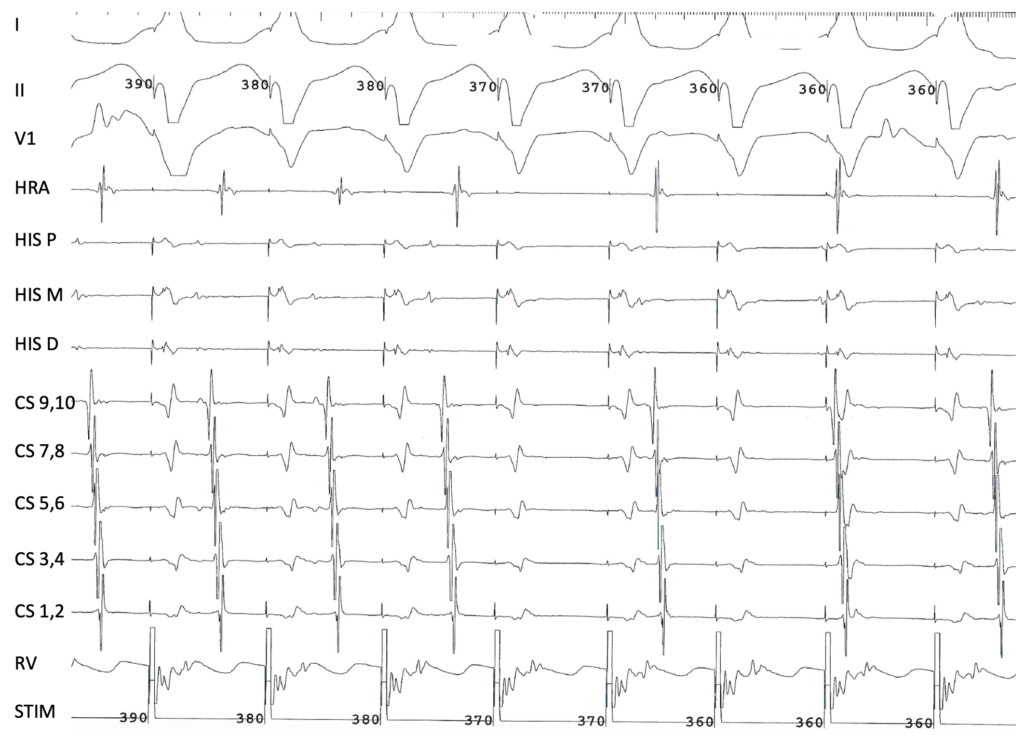 SVT Case Study - #2 - EP Essentials