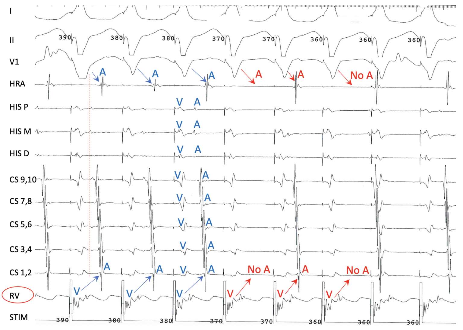 SVT Case Study - #2 - EP Essentials