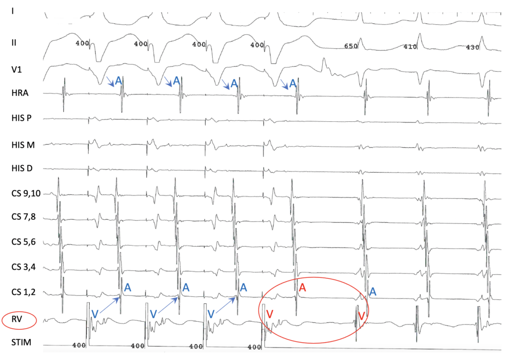 SVT Case Study - #2 - EP Essentials