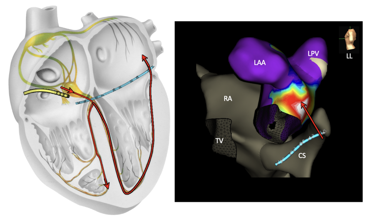 Electrogram Interpretation - 21 - EP Essentials