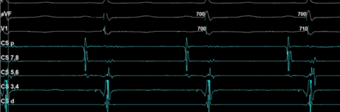 EP 101 - Signals & Catheter Positioning - EP Essentials