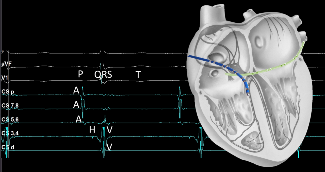 EP 101 - Signals & Catheter Positioning - EP Essentials