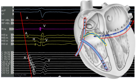 EP 101 - Catheter Placement - EP Essentials