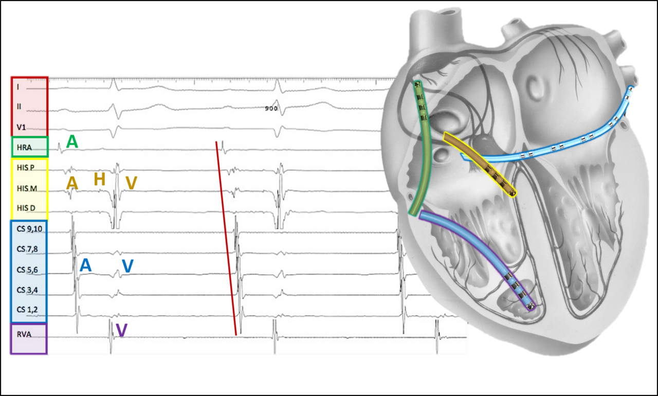 EP 101 - More Signals & Catheters - EP Essentials