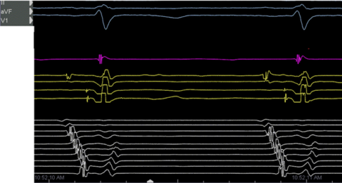 EP 101 - Catheter Placement - EP Essentials